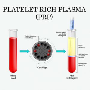 Platelet Rich Plasma (PRP) – IVF Blogs