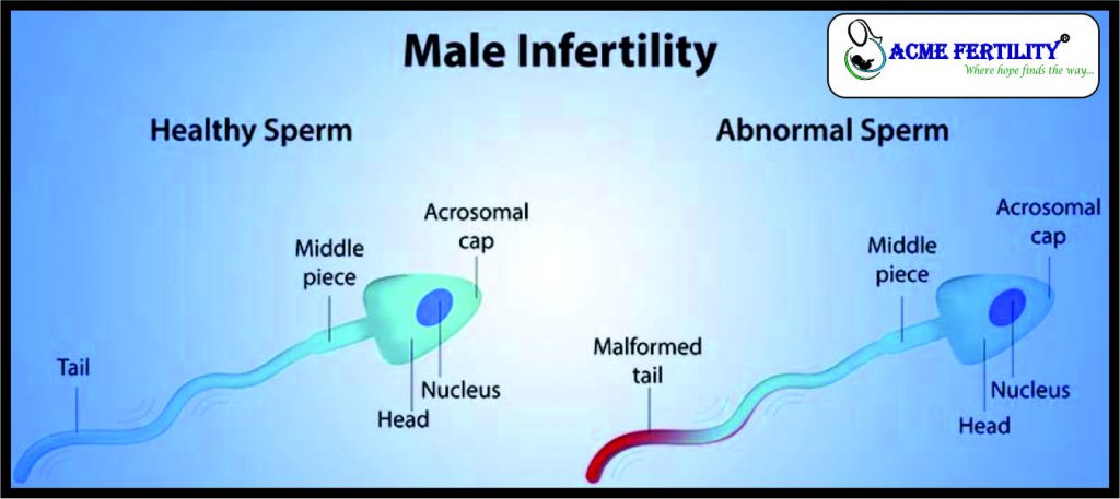 Male Infertility – IVF Blogs
